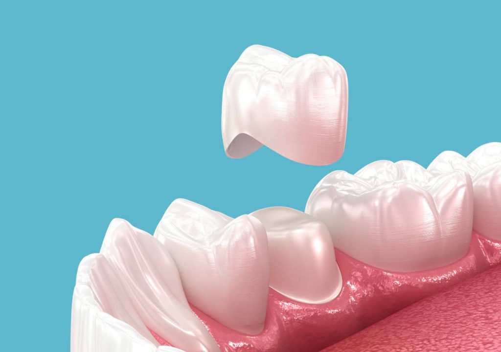 What Does a Dental Crown Look Like? | Shodhan Dentistry Yucaipa